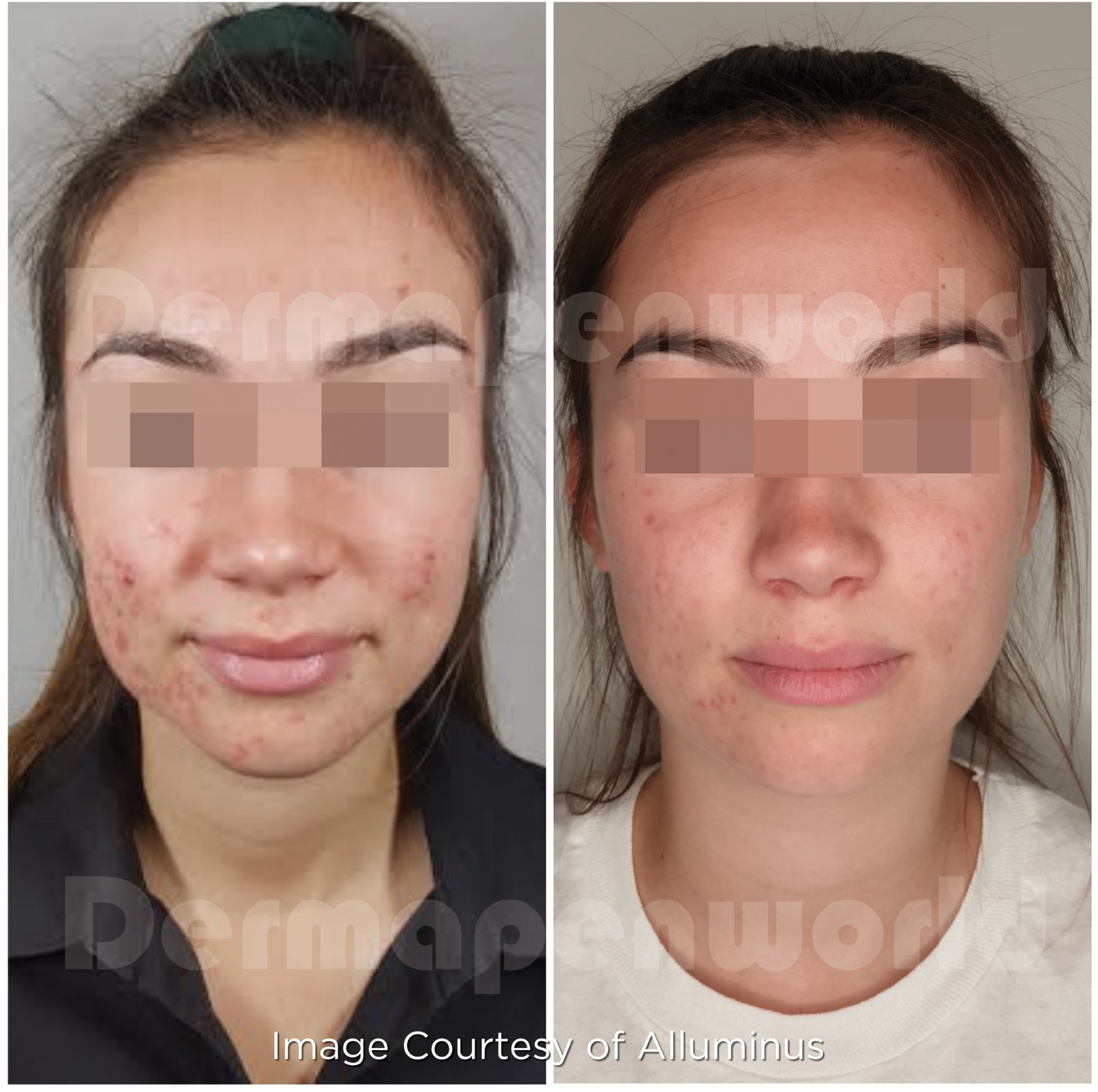 Microneedling - AK Aesthetics High Wycombe | Non-surgical aesthetic ...